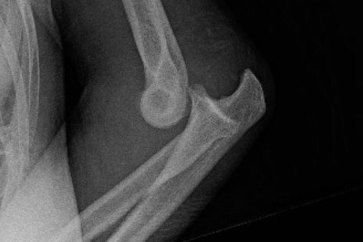 UFC: Dana White shares brutal elbow injury X-Ray from Istela Nunes ...
