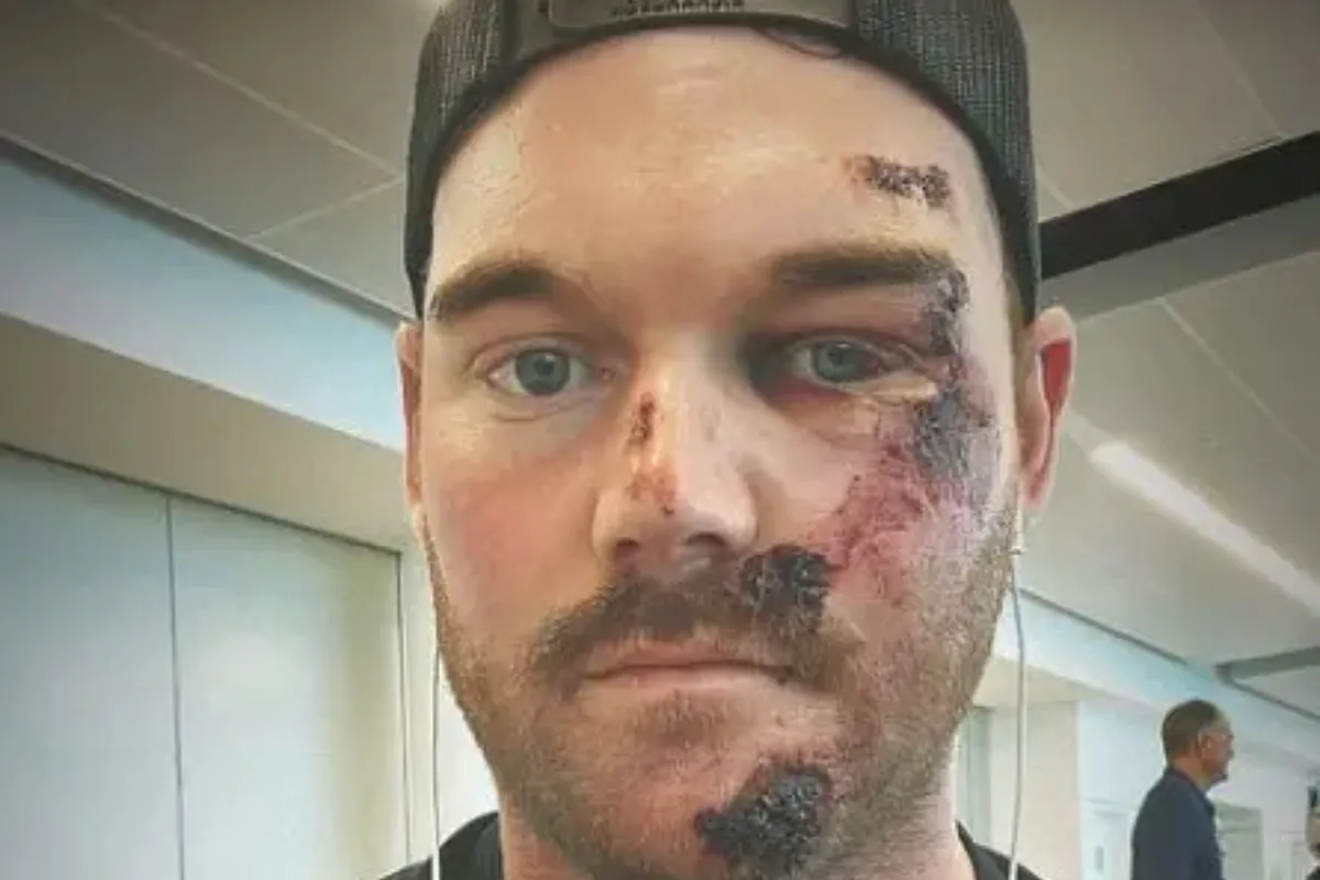 Grayson Murray survived a nearly fatal scooter accident, but lost his ...